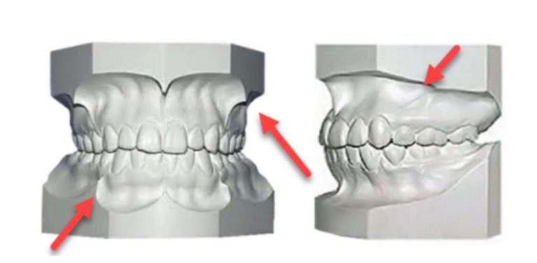 Diagnostic Wax up Dimple Technique - Implant Concierge