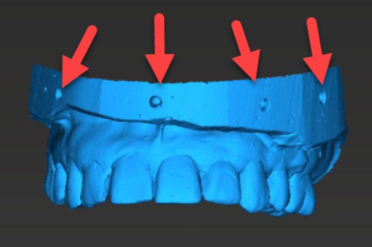 Diagnostic Wax up Dimple Technique - Implant Concierge