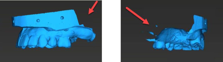 Diagnostic Wax up Dimple Technique - Implant Concierge
