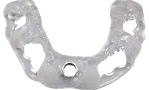 Tooth Borne Guide - Implant Concierge