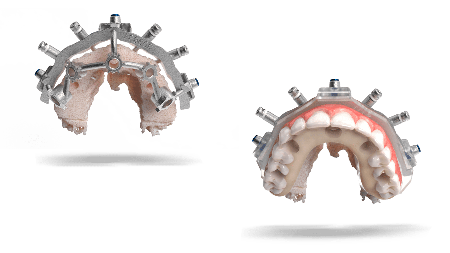 CHROME GuidedSMILE™ Guide Package - Implant Concierge